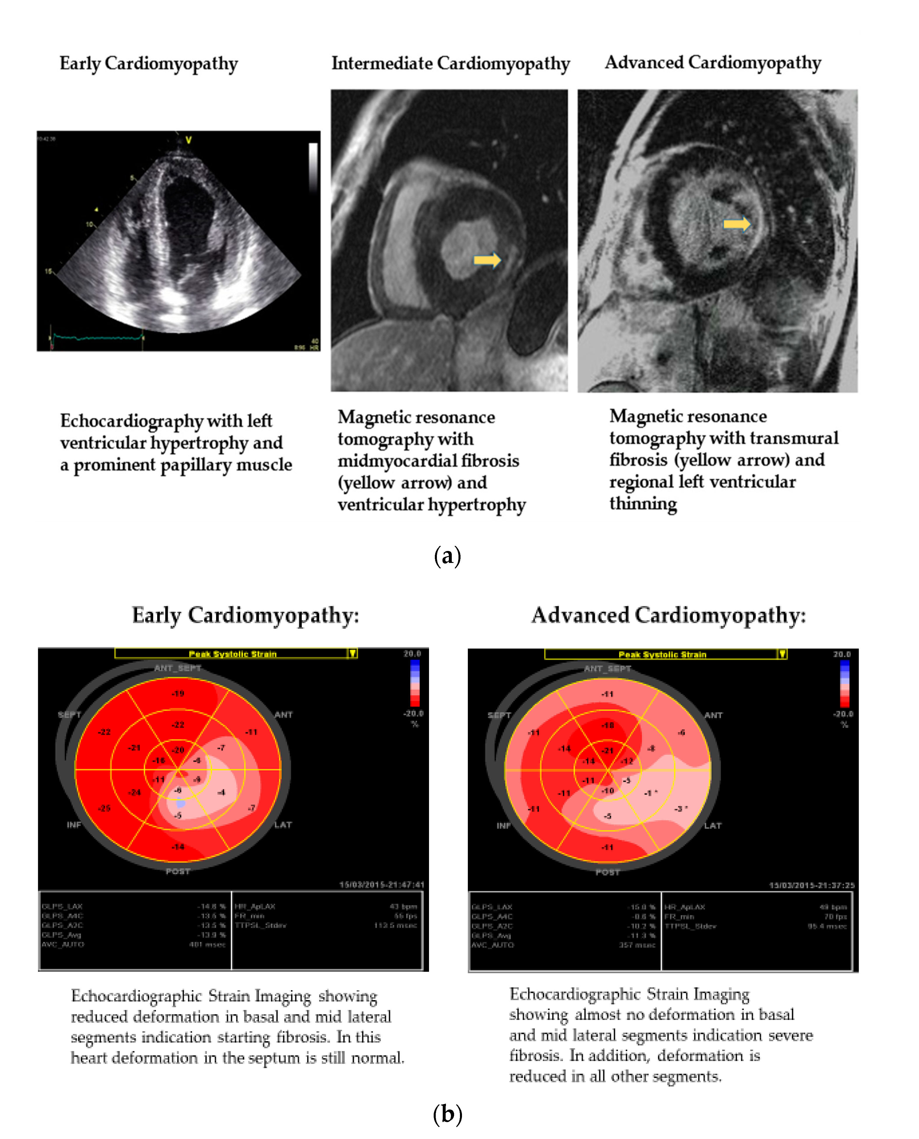 Fabry Cardiomyopathy: Current Treatment and Future Options