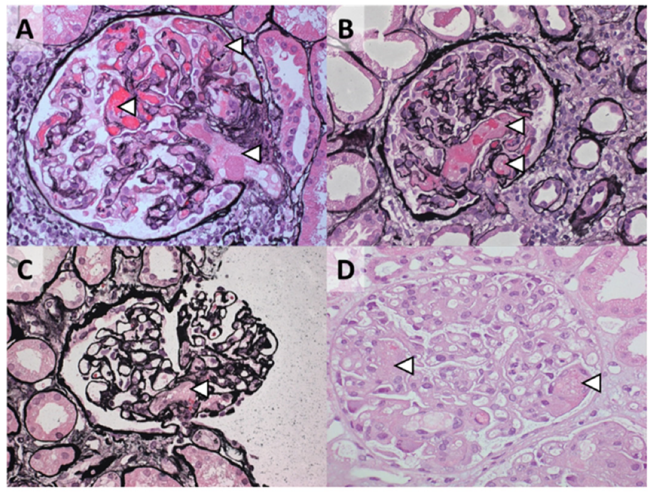 The Syndromes of Thrombotic Microangiopathy: A Critical Appraisal on ...