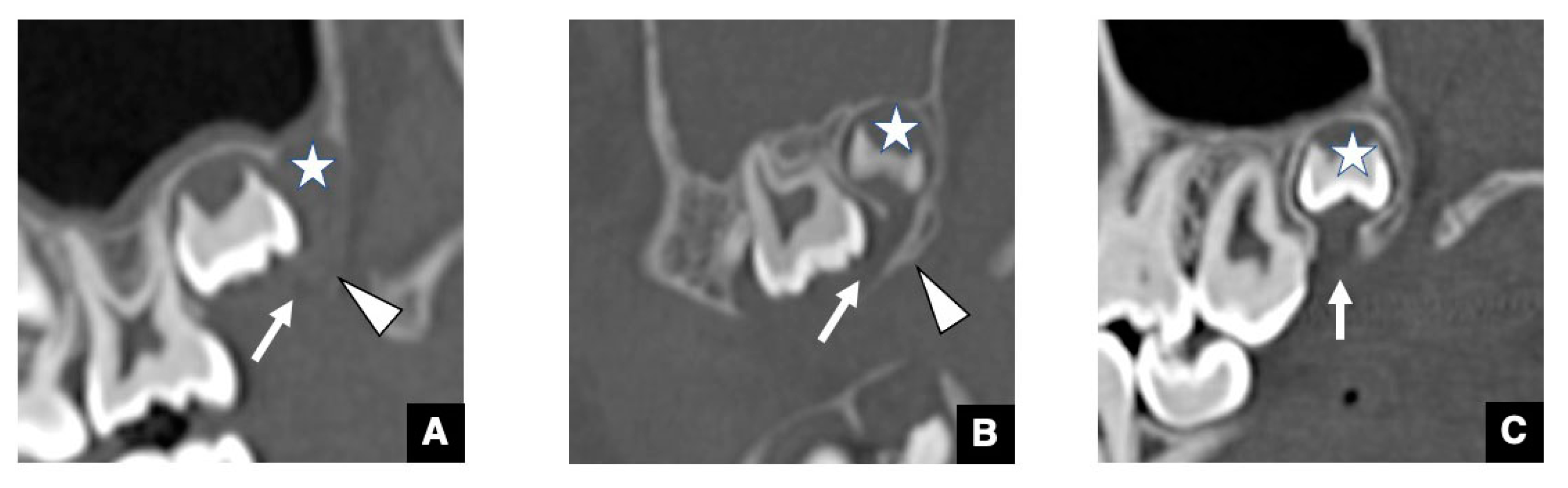 Overview of Radiological Studies on Visualization of Gubernaculum ...