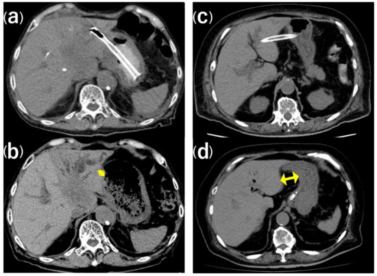Risk Factors for Stent Migration into the Abdominal Cavity after ...