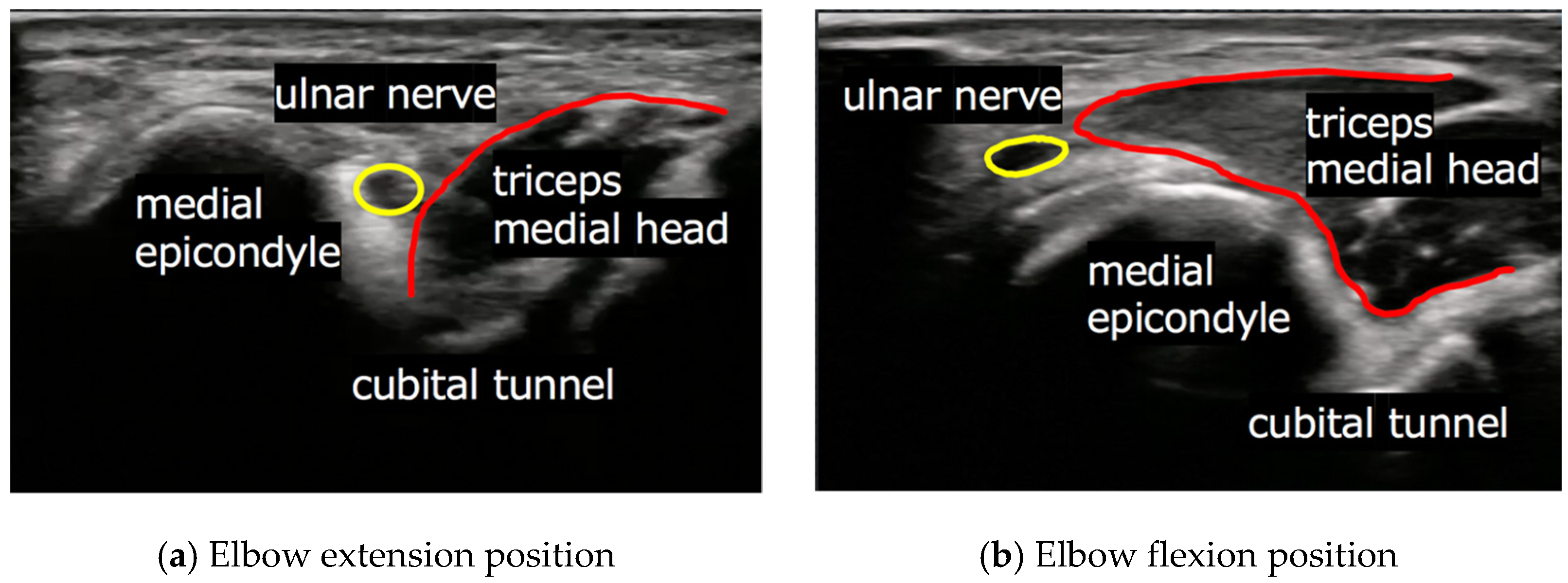 Ulnar Nerve Anatomy Cross Section