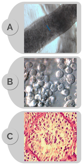 Differential Diagnosis of Azoospermia in Men with Infertility