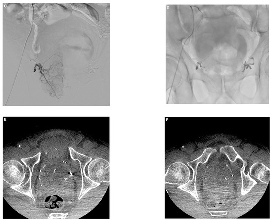 Jcm Free Full Text Prostate Artery Embolization Using N Butyl