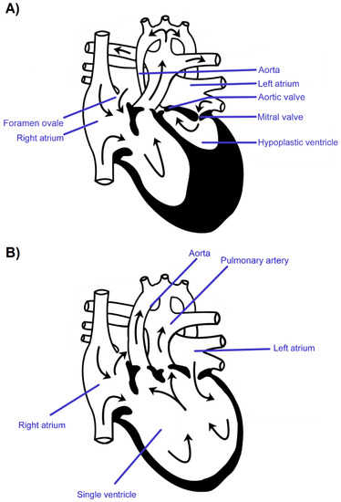 Seasonality of Hypoplastic Left Heart Syndrome and Single Ventricle ...