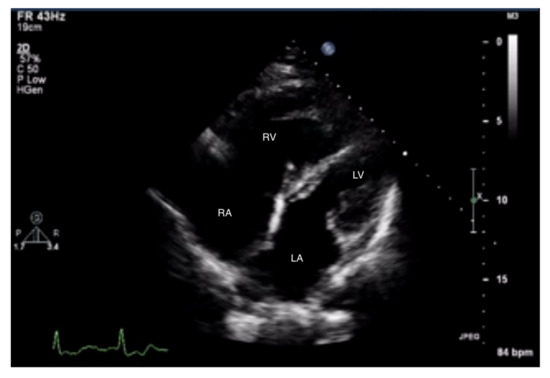 Echocardiography in Pulmonary Arterial Hypertension: Comprehensive ...