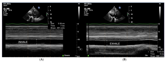 Echocardiography in Pulmonary Arterial Hypertension: Comprehensive ...