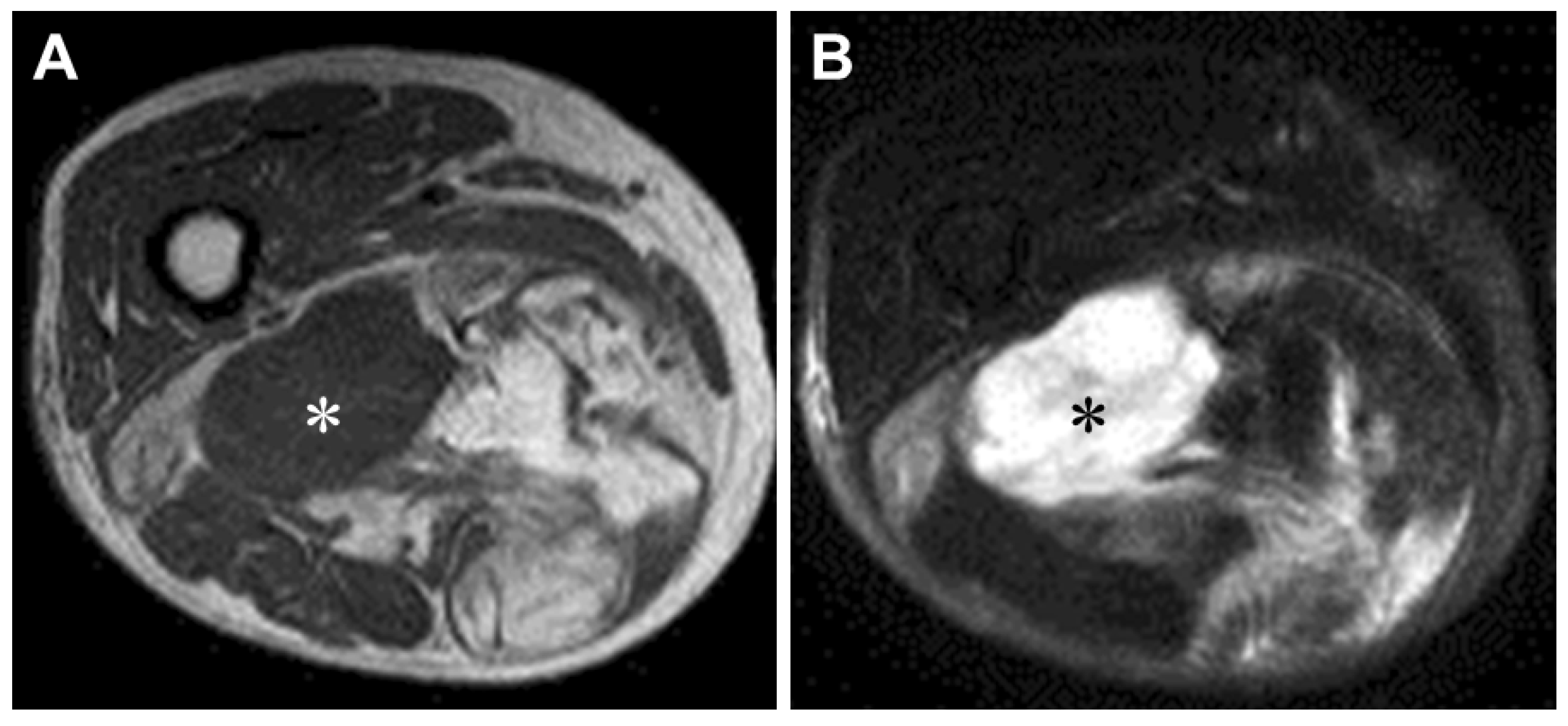 Dedifferentiated Liposarcoma Pathology Outlines Dedifferentiated Liposarcoma