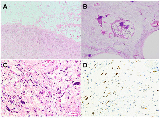 Biology and Management of Dedifferentiated Liposarcoma: State of the ...