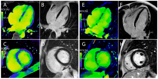 Diagnostic Performance of Extracellular Volume Quantified by Dual-Layer ...