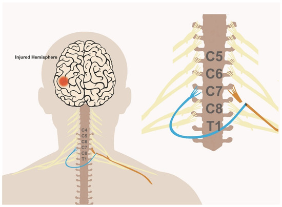 Contralateral C7 Nerve Transfer for Stroke Recovery: New Frontier for Peripheral Nerve Surgery
