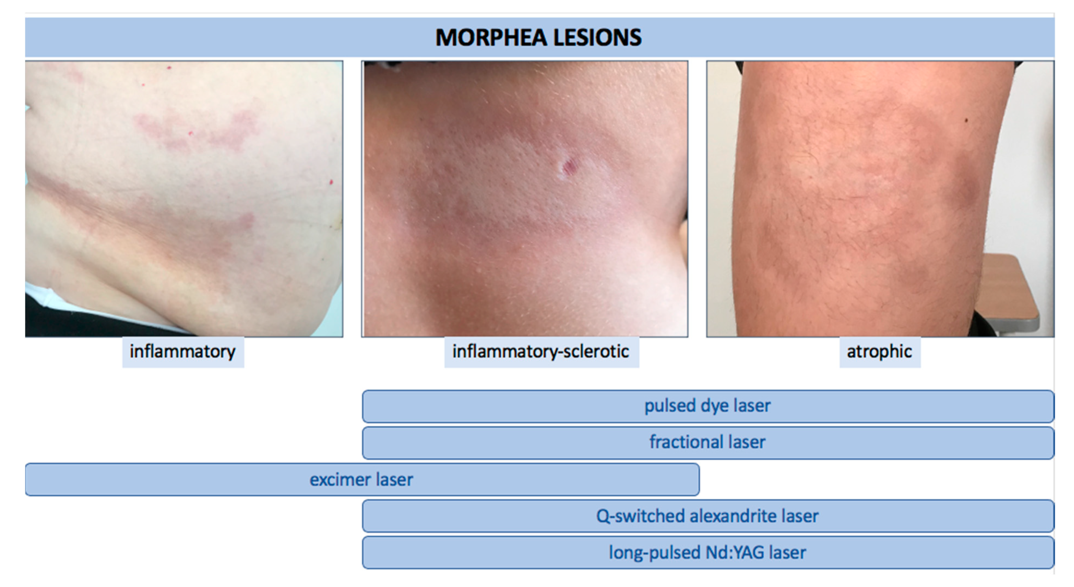 Jcm Free Full Text Laser Therapy For The Treatment Of Morphea A