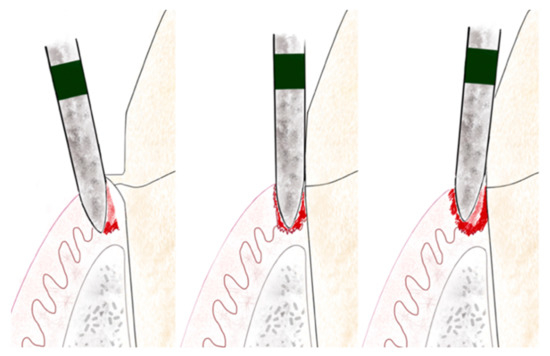 Periodontal Behavior and Patient Satisfaction of Anterior Teeth ...