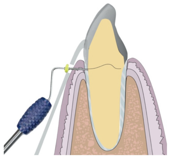 Periodontal Behavior and Patient Satisfaction of Anterior Teeth ...
