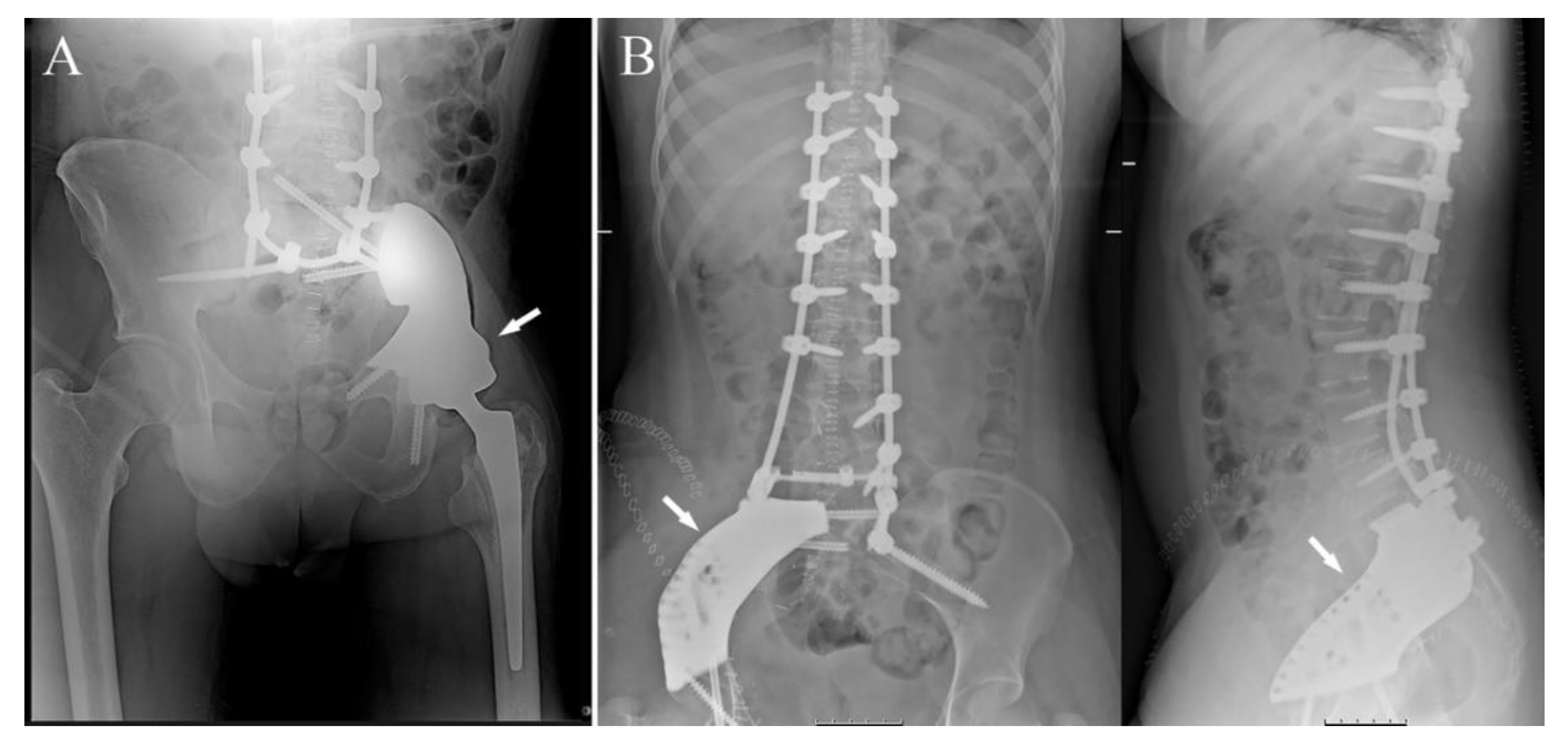 3D-Printed Titanium Custom-Made Prostheses in Reconstruction after ...