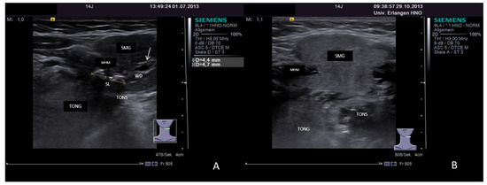 Parotid Abscess Ultrasound