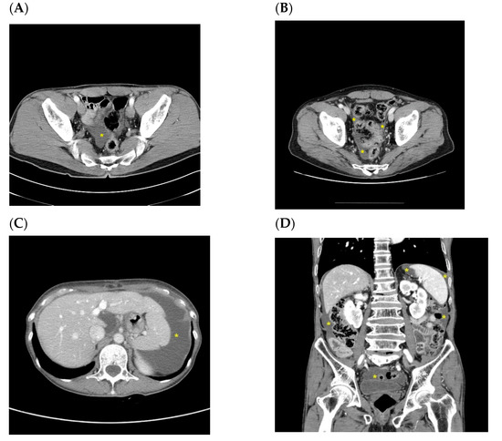 Prevalence and Clinical Implications of Ascites in Gastric Cancer ...
