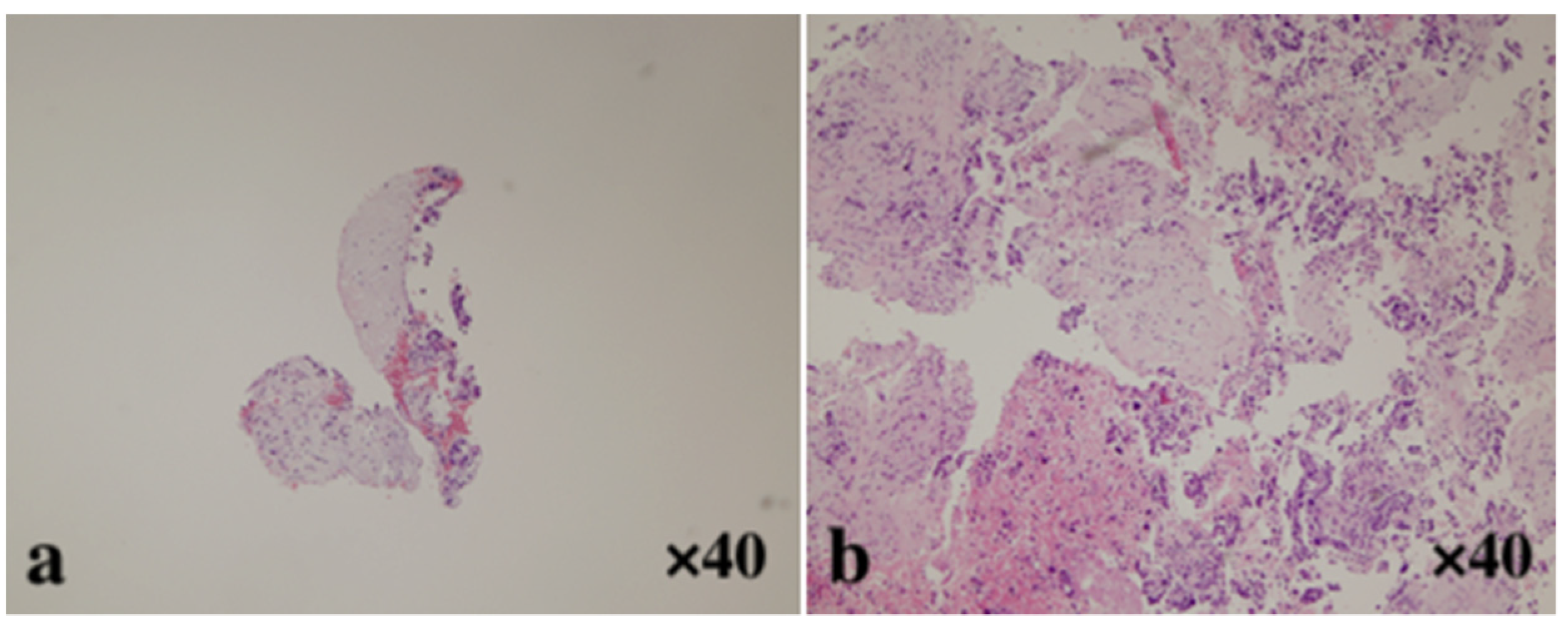 Comparison of Histological Sample Volumes among Various Endoscopic ...