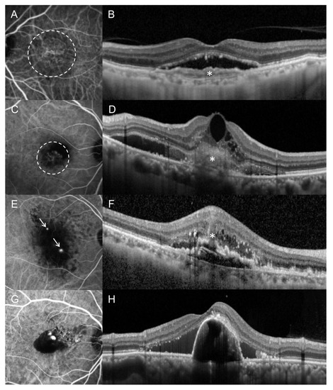 Investigation of the Trend of Selecting Anti-Vascular Endothelial ...