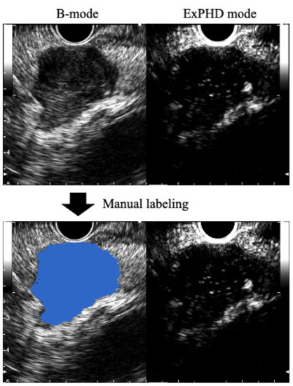 Automatic Segmentation of Pancreatic Tumors Using Deep Learning on a ...