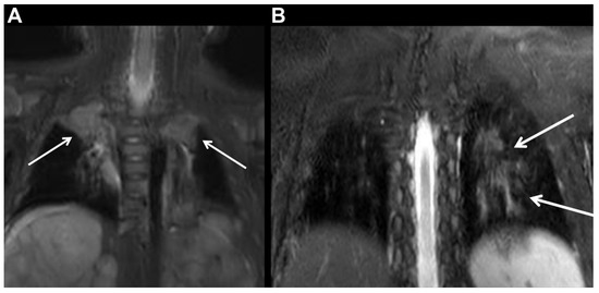 Factors Associated with Occurrence of Atelectasis during Sedation for ...