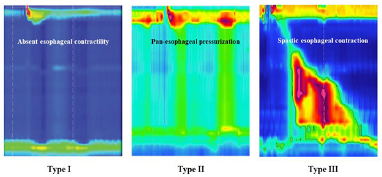 Diagnosis and Management of Achalasia: Updates of the Last Two Years