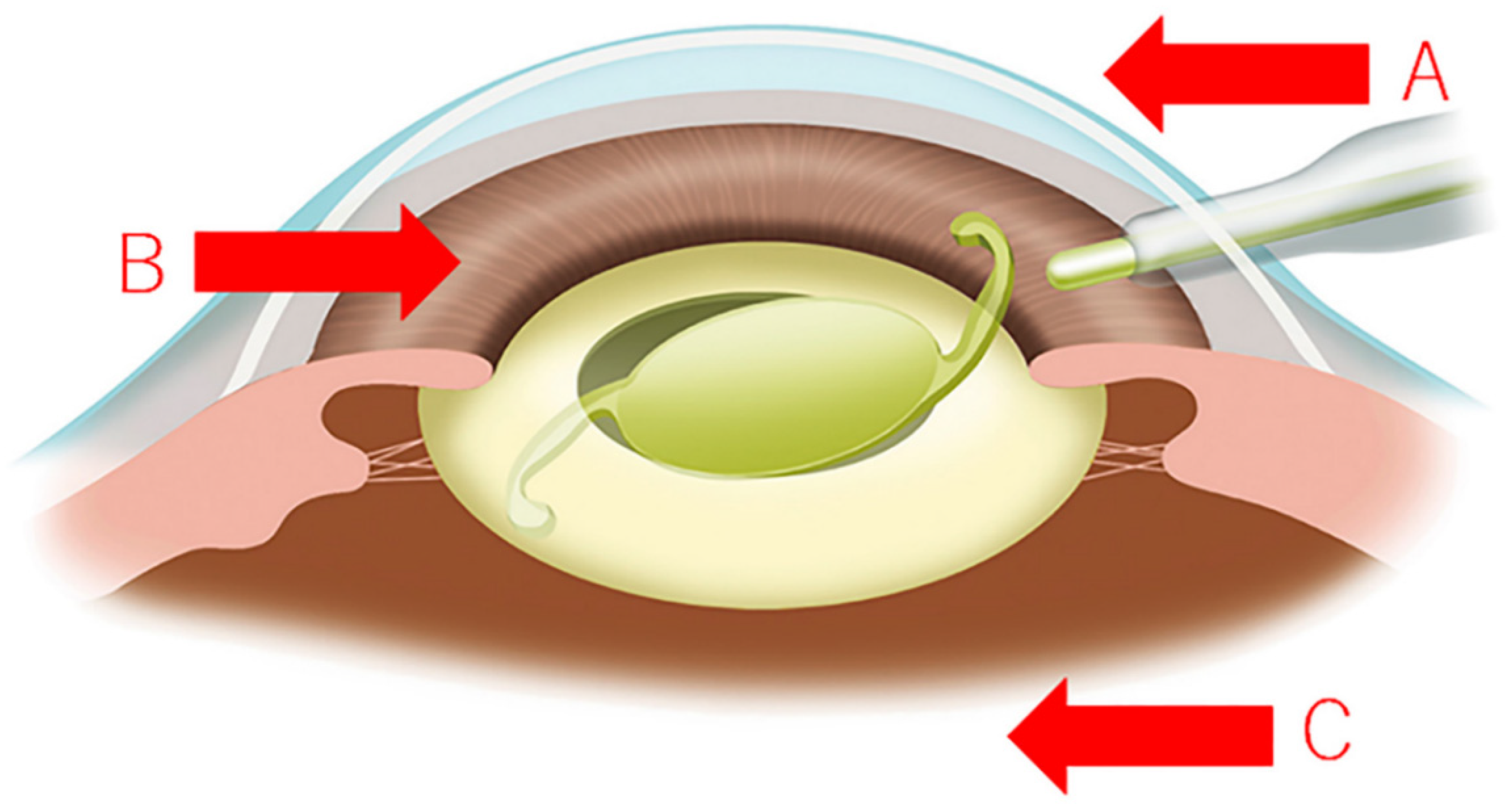 Cataract Surgery by Intraoperative Surface Irrigation with 0.25% ...