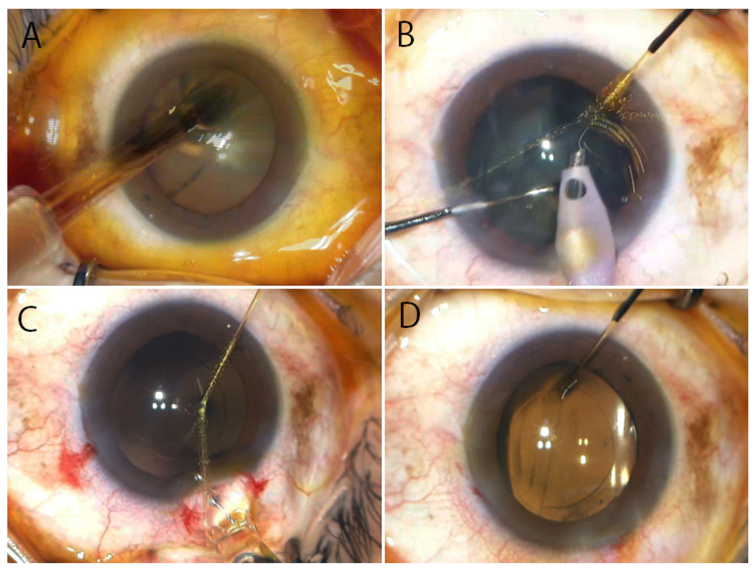 Cataract Surgery by Intraoperative Surface Irrigation with 0.25% ...