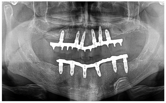 Functional Outcomes with Facial Artery Musculo-Mucosal (FAMM) Flap and ...