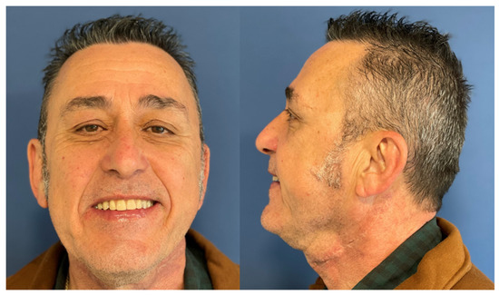 Functional Outcomes with Facial Artery Musculo-Mucosal (FAMM) Flap and ...