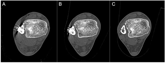 The Impact of Suture Button Removal in Syndesmosis Fixation