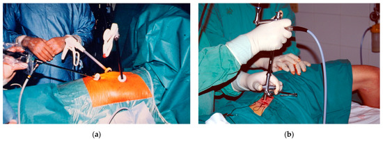 Thoracoscopy for Spontaneous Pneumothorax