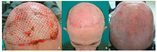 Clinical and Surgical Outcomes in Extensive Scalp Reconstruction after ...
