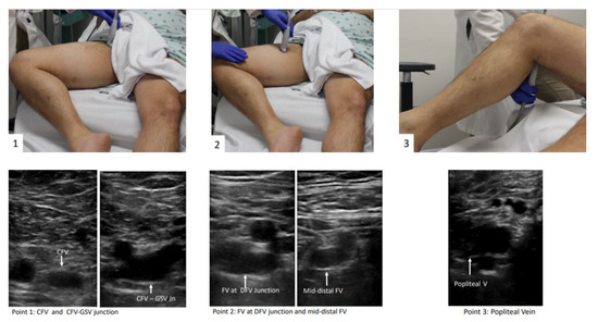 The Use of Point-of-Care Ultrasound (POCUS) in the Diagnosis of Deep ...
