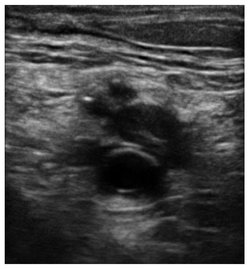 The Use of Point-of-Care Ultrasound (POCUS) in the Diagnosis of Deep ...