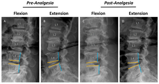 Pain Control Affects the Radiographic Diagnosis of Segmental ...