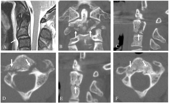 Proposal of Treatment Strategy for Pedicle Fractures of the C2: An ...