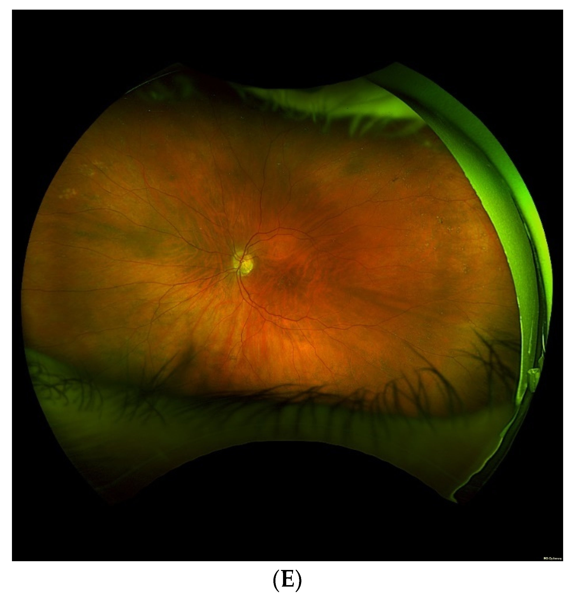 Peripheral Manifestations in Age Related Macular Degeneration: A Review ...