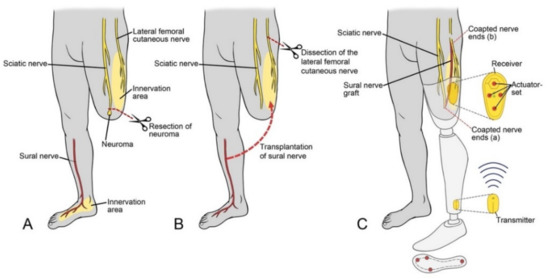 Reduction of Phantom Limb Pain and Improved Proprioception through a ...