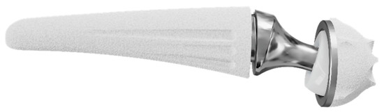 TOUCH® Prosthesis for Thumb Carpometacarpal Joint Osteoarthritis: A ...