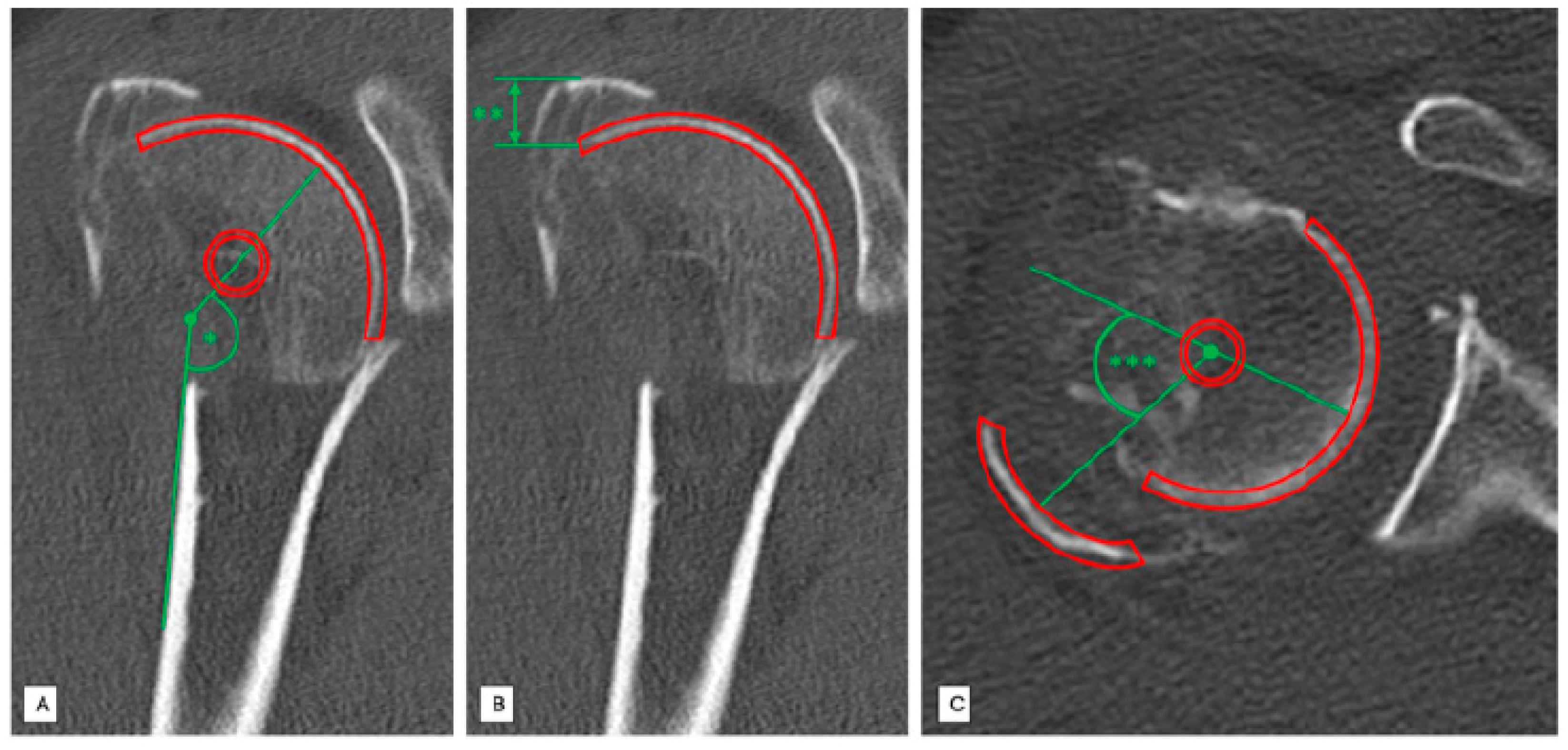 Displacement of the Greater Tuberosity in Humeral Head Fractures Does ...