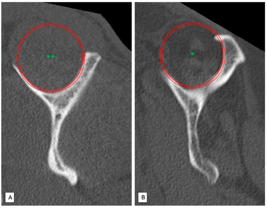 Displacement of the Greater Tuberosity in Humeral Head Fractures Does ...