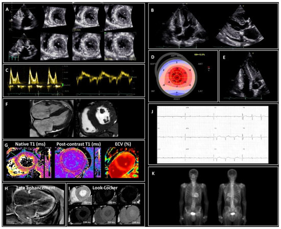 Aortic Valve Stenosis and Cardiac Amyloidosis: A Misleading Association