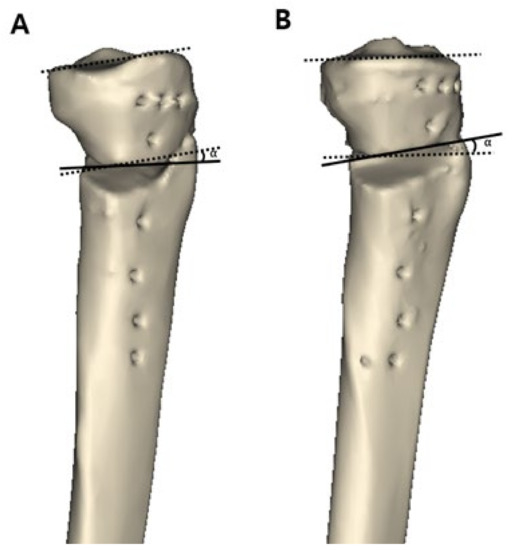 Effect of the Osteotomy Inclination Angle in the Sagittal Plane on the ...