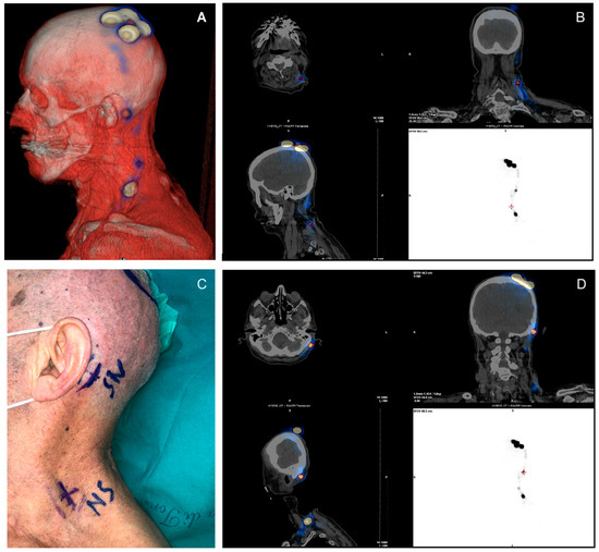 Jcm Free Full Text Non Sentinel Lymph Node Detection During