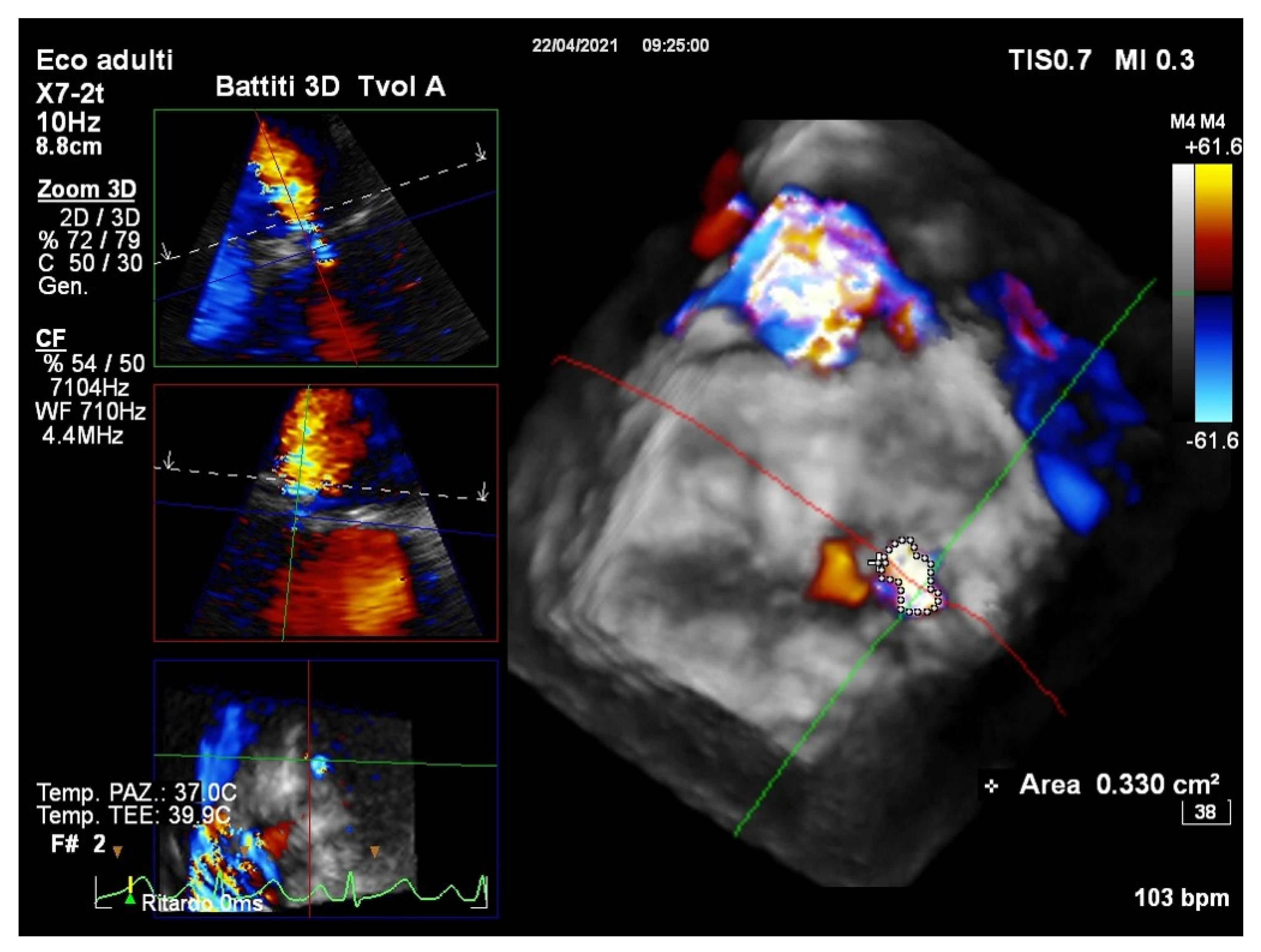 The Common Combination of Aortic Stenosis with Mitral Regurgitation ...