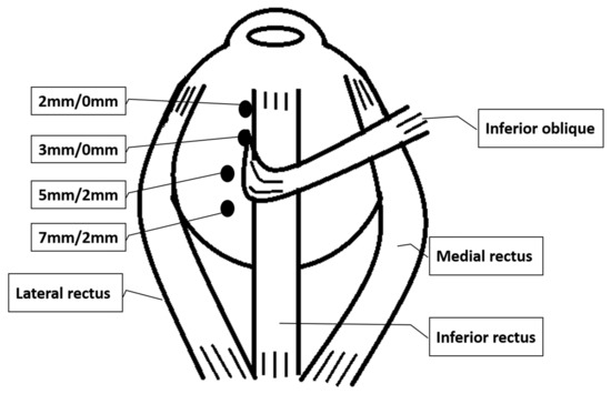 The Effects of Modified Graded Recession, Anteriorization and Myectomy ...