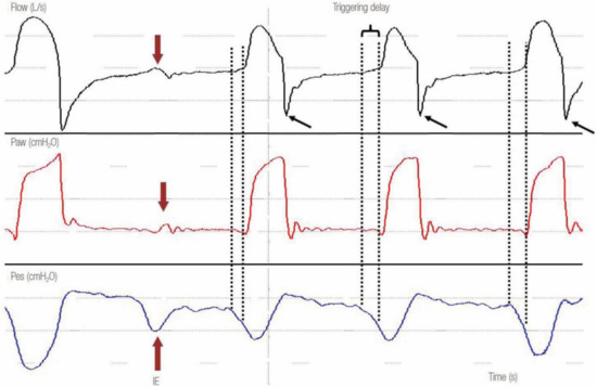 Patient–Ventilator Dyssynchrony in Critically Ill Patients
