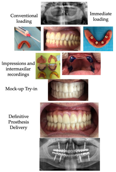 JCM | Special Issue : Latest Advances in Prosthodontics: Improving ...