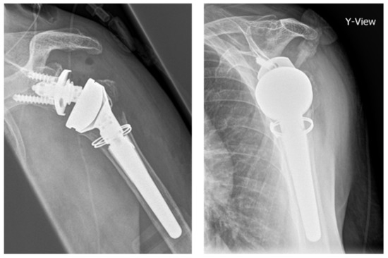 Biomechanical Value of a Protective Proximal Humeral Cerclage in ...
