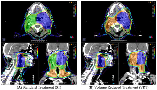 Reduction of Elective Radiotherapy Treatment Volume in Definitive ...